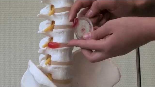 Opération de la hernie discale, tout ce qu’il faut savoir - J3M